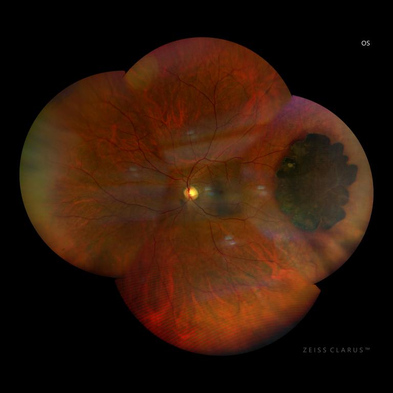 ZEISS CLARUS 700 Case Studies