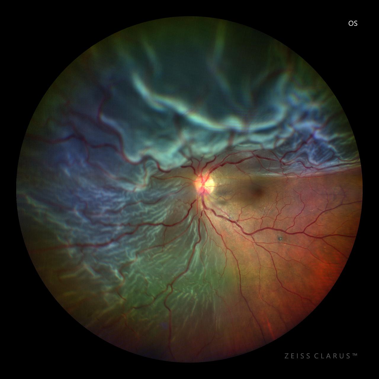 ZEISS CLARUS 700 Case Studies