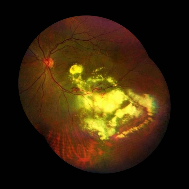 ZEISS CLARUS 700 Case Studies