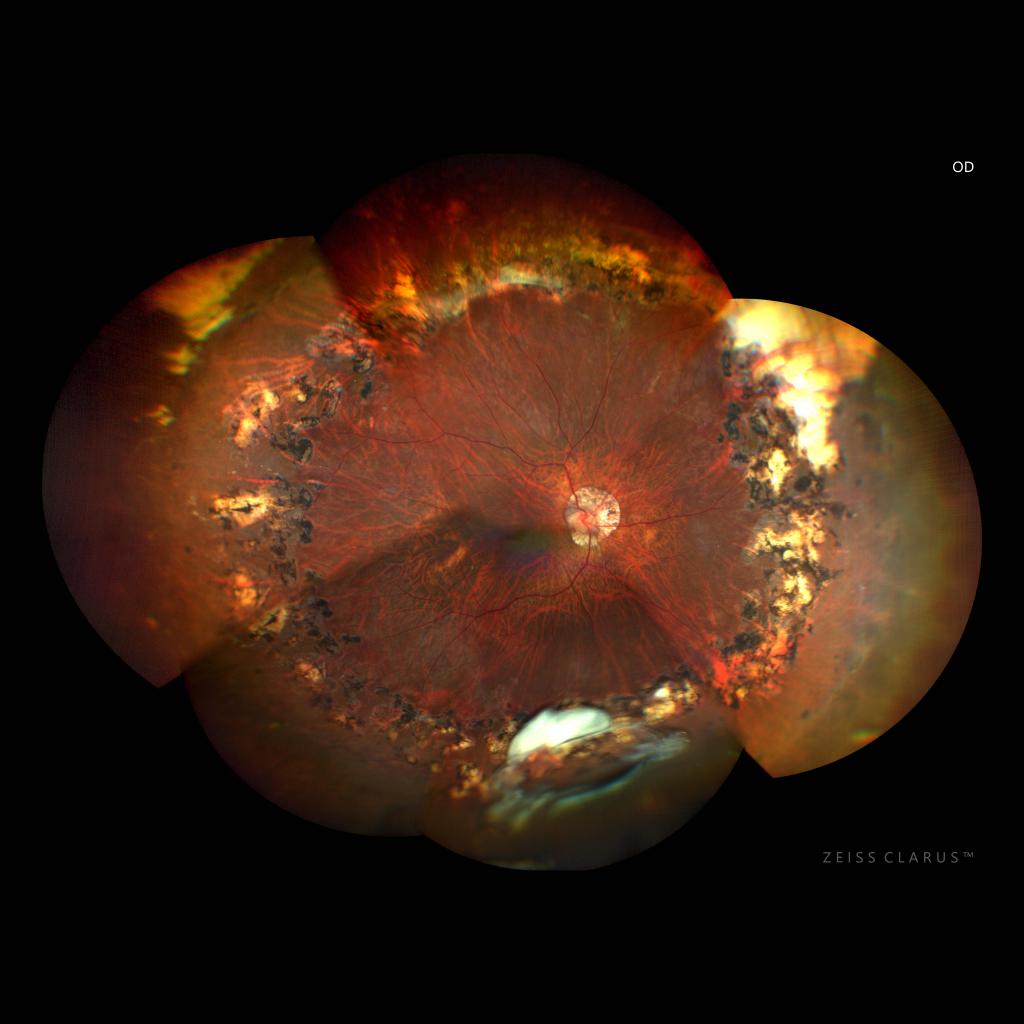 ZEISS CLARUS 700 Case Studies