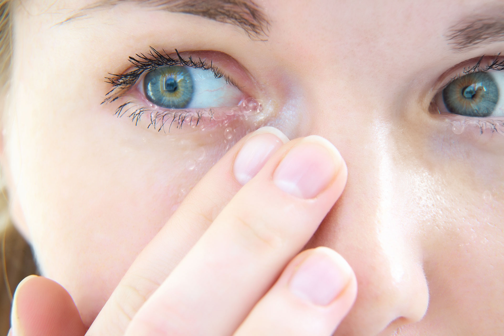 Health problem: watery eyes